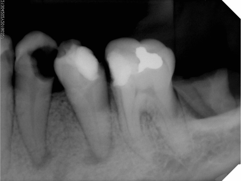 Use of MTA-FILLAPEX and BIO-C SEALER endodontic sealers in pulp ...