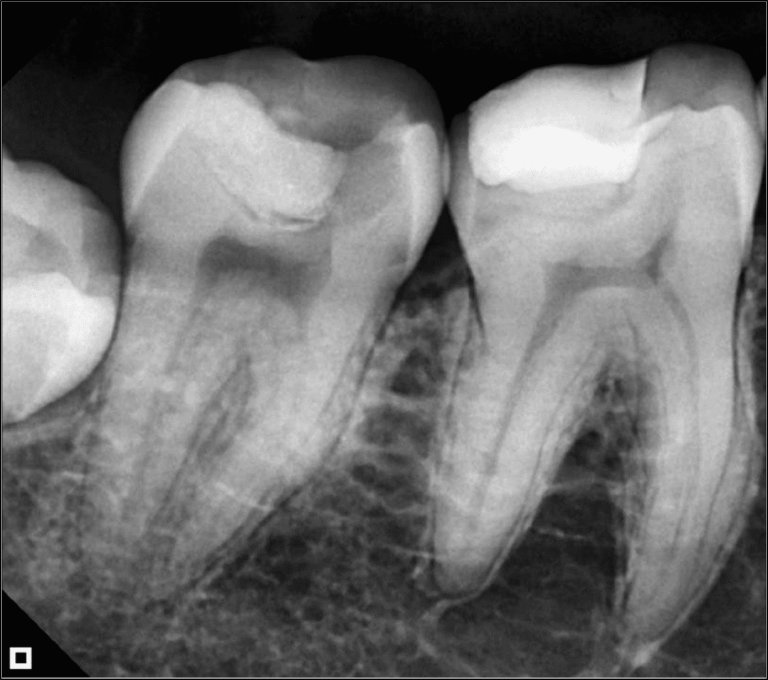 Direct and indirect pulp capping using Bio-C Repair bioceramic cement ...