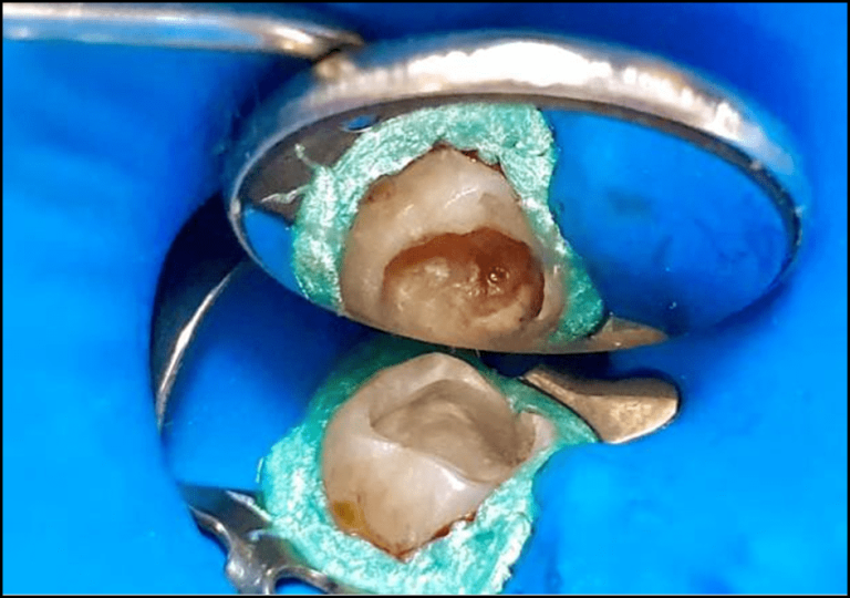 Direct and indirect pulp capping using Bio-C Repair bioceramic cement ...