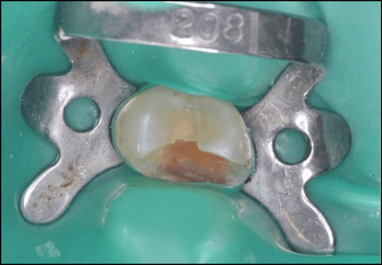 Capeamento pulpar direto e indireto usando BIO-C REPAIR