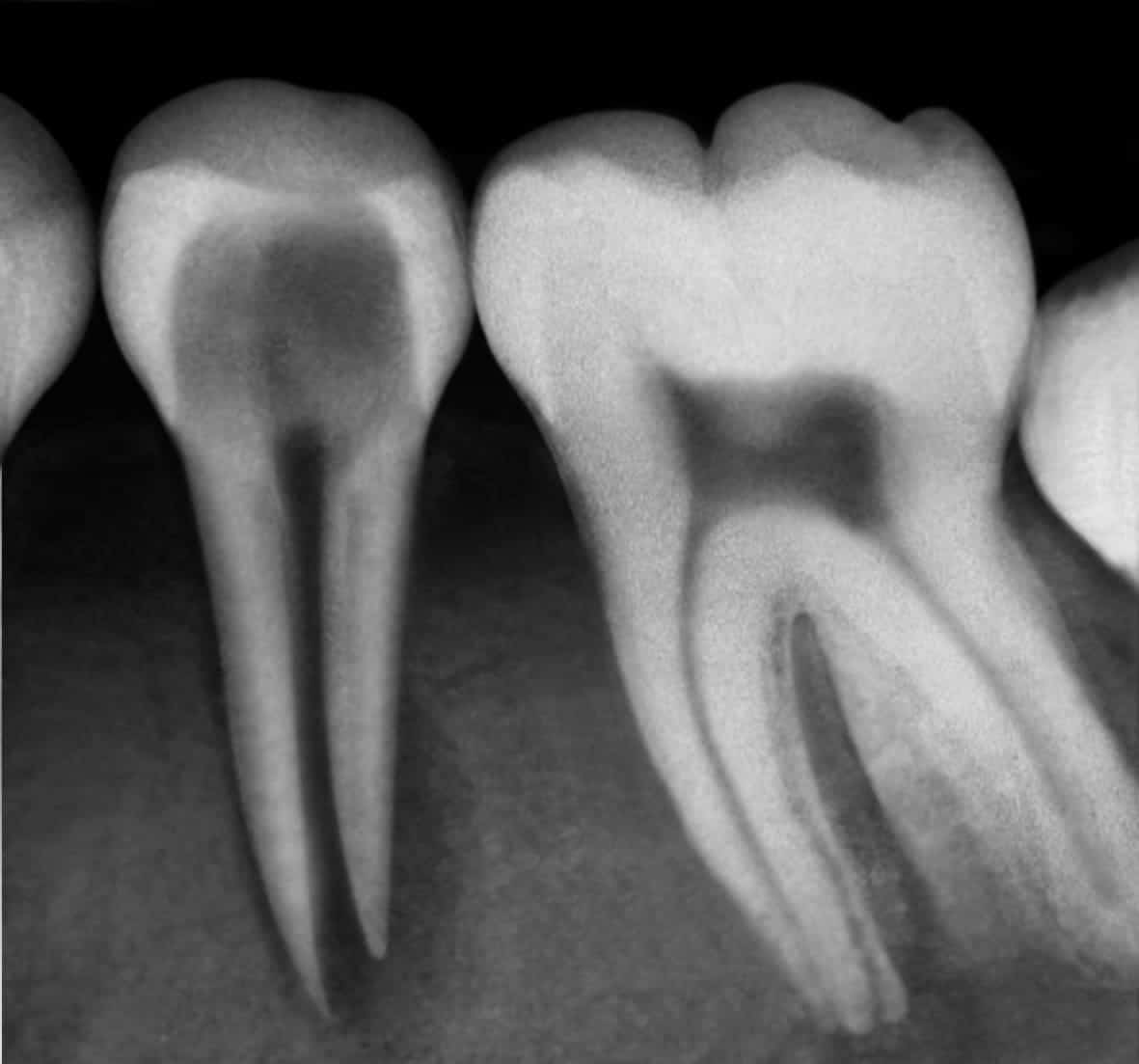 Apicificação dentária utilizando materiais biocerâmicos - Angelus ...