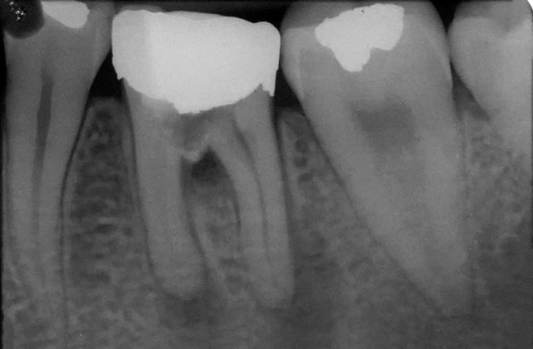 Tratamento endodôntico do elemento dental 36: Relato de caso